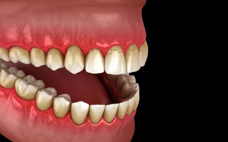 ¿Qué es la periodoncia? Aclaramos tus dudas | eden.clinic