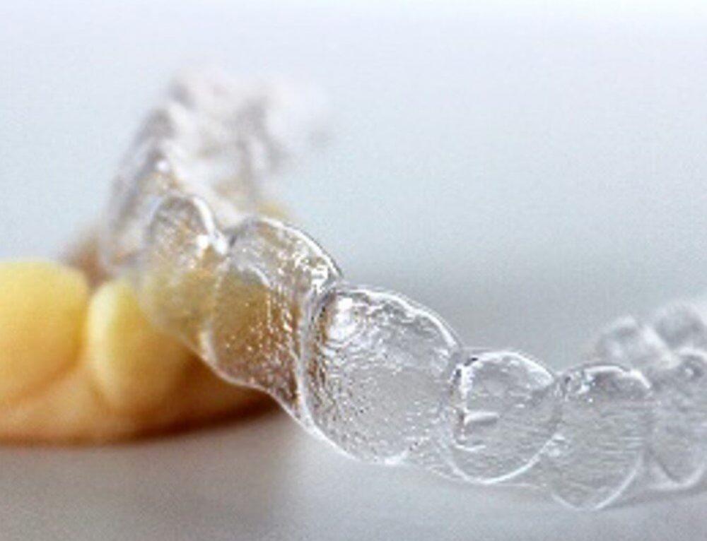 ¿Qué es la maloclusión de clase 1 o mordida perfecta ? - eden.clinic