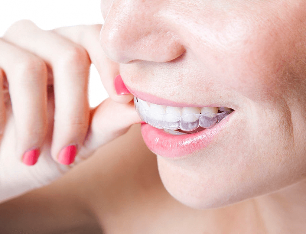 ¿Qué es la maloclusión de clase 1 o mordida perfecta ? - eden.clinic