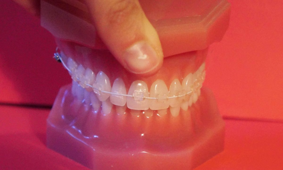 ¿Cómo es el antes y después de la mordida profunda? 🔁 | eden.clinic